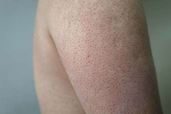 Rough and Bumpy Skin & Keratosis Pilaris Explained ...